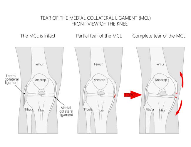 MCL AND LCL LIGAMENT INJURY SOLUTION - BioSkin LLC