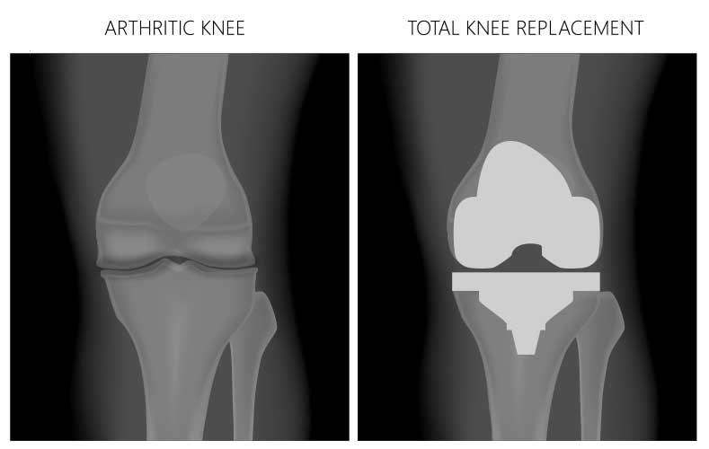 Post Knee Surgery Recovery: Braces, Support, and Care