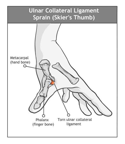 Thumb Sprain or Skier’s Thumb: Causes and Treatment