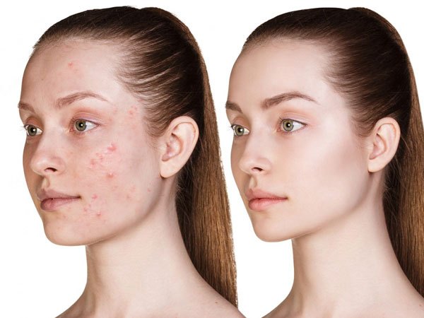 Ideas For Reducing And Eliminating Acne Issues - Skin Beauty