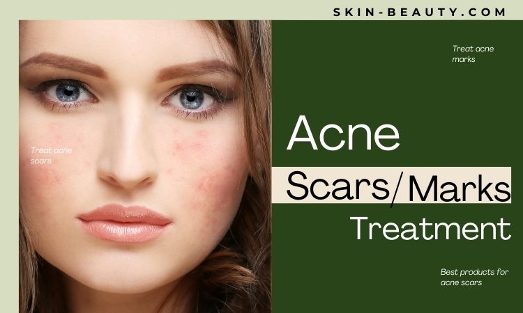 Navigating Treatments: Acne Scars vs. Acne Marks Unveiled - Skin Beauty