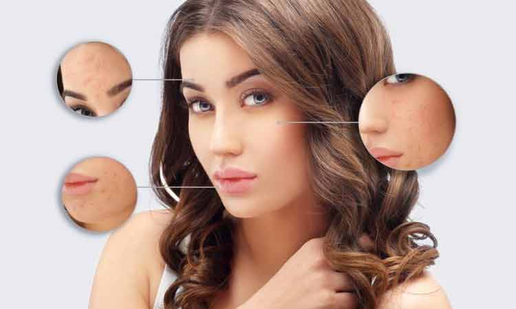 5 Causes Of Blemishes On The Face | Skin Beauty - Skin Beauty