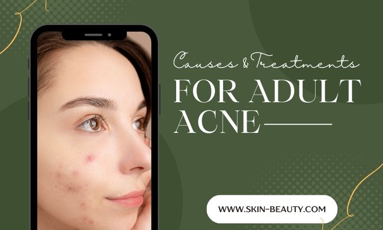 Causes and Treatment Options for Adult Acne - Skin Beauty