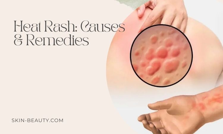 Understanding Heat Rash: Causes and Remedies - Skin Beauty