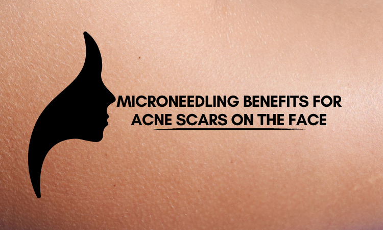 Micro-needling Benefits for Acne Scars on the Face - Skin Beauty
