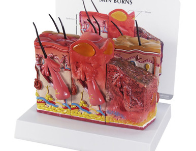 Skin Burn Degree Educational Anatomy Model