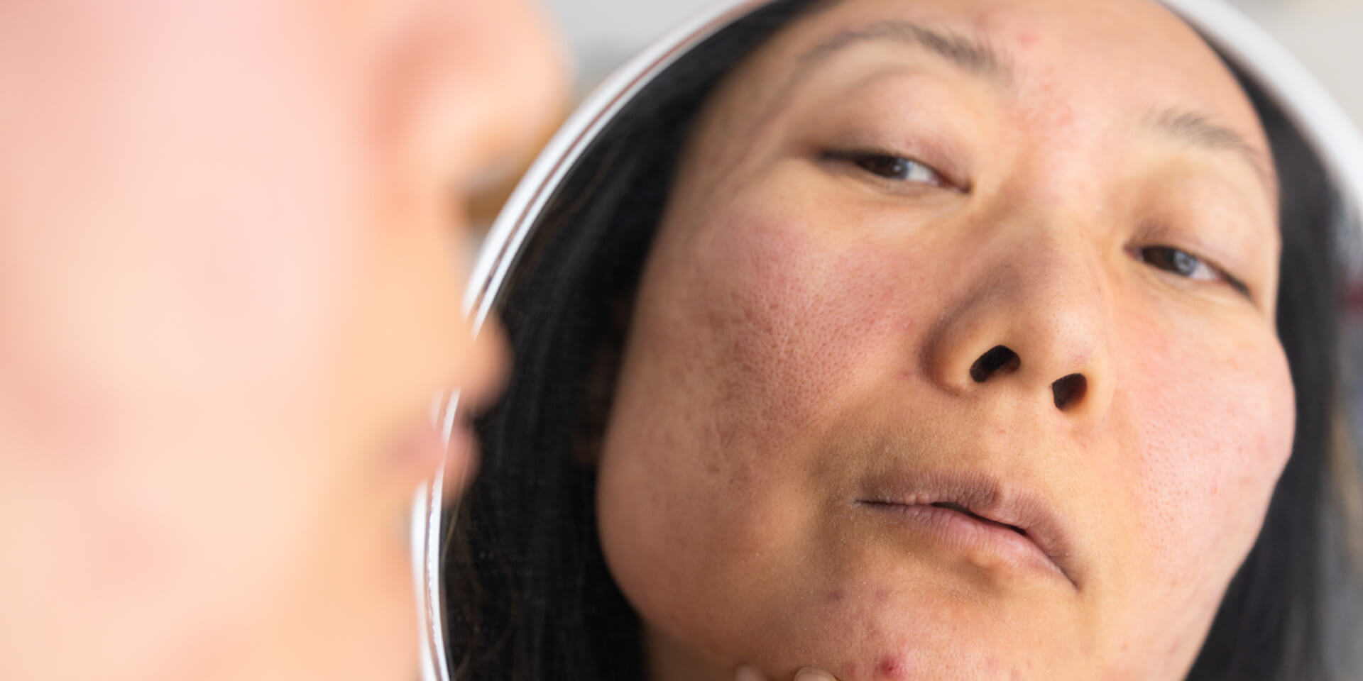 What causes dry skin and the best treatment | SK-II US