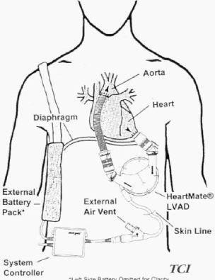 Shop Medline DM585 - LVAD Management System Chronic Online | Medical Mega