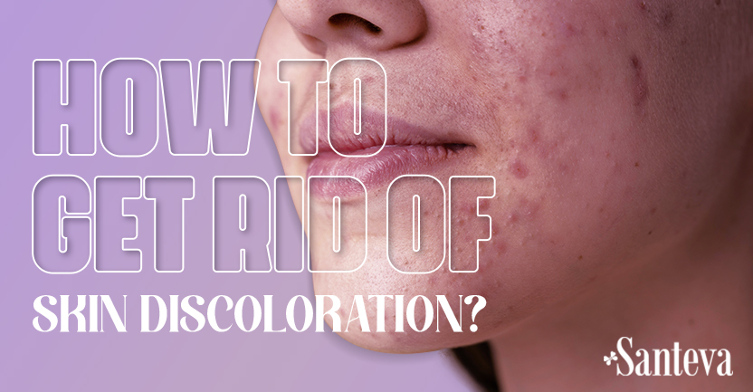 How to Get Rid of Skin Discoloration? - Santeva