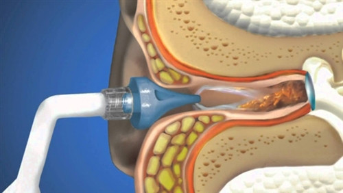 Bionix OtoClear Ear Irrigation Tips | LIBERTY Health Supply
