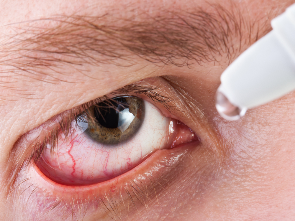 When Dry Eye Strikes - Speert International