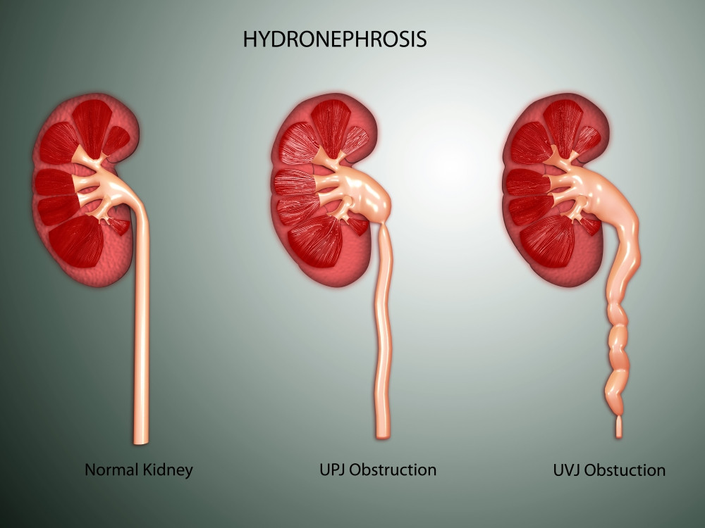 Hydronephrosis is a condition that typically occurs when one kidney ...