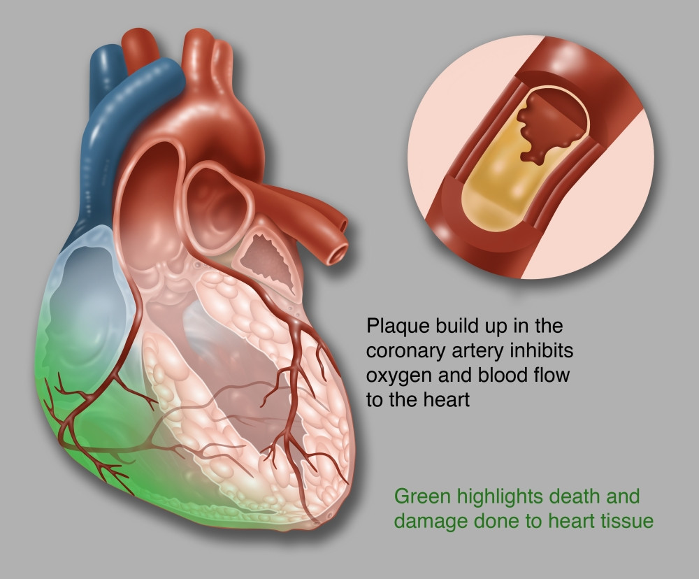 Acute Heart Failure Poster Print by Gwen Shockey/Science Source - Item ...
