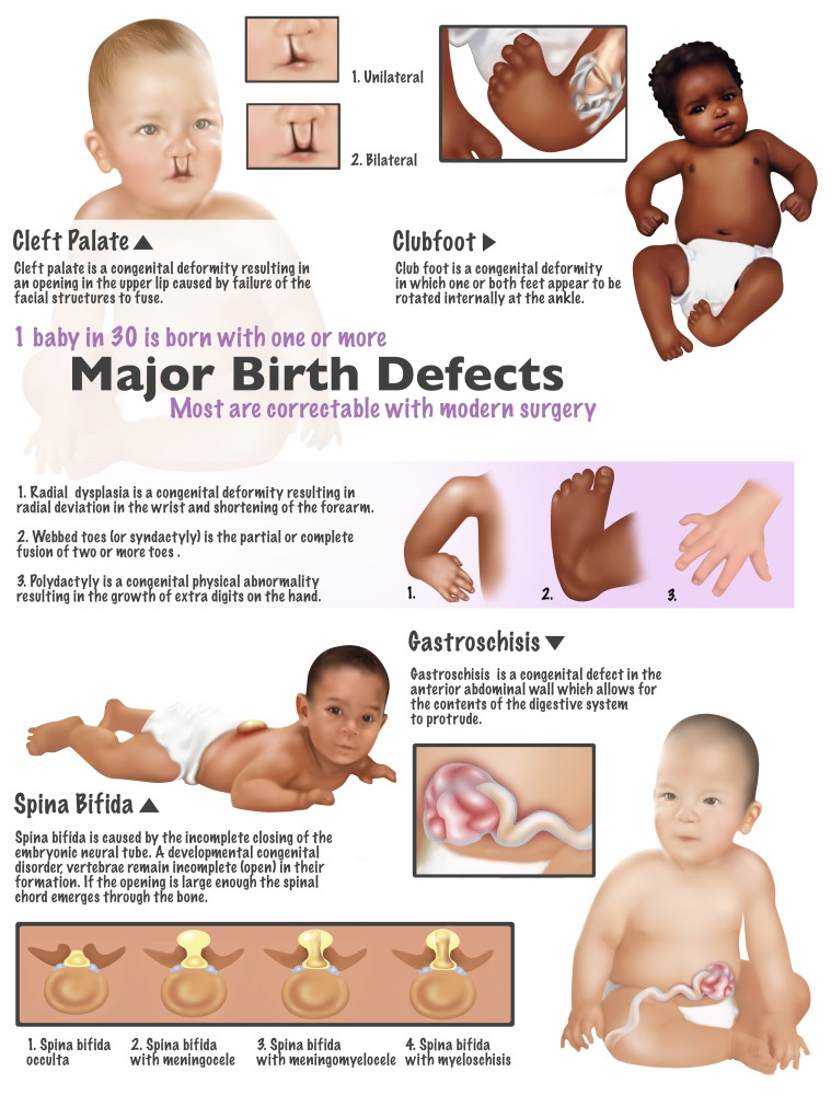 Birth Defects in Babies Poster Print by Gwen Shockey/Science Source ...