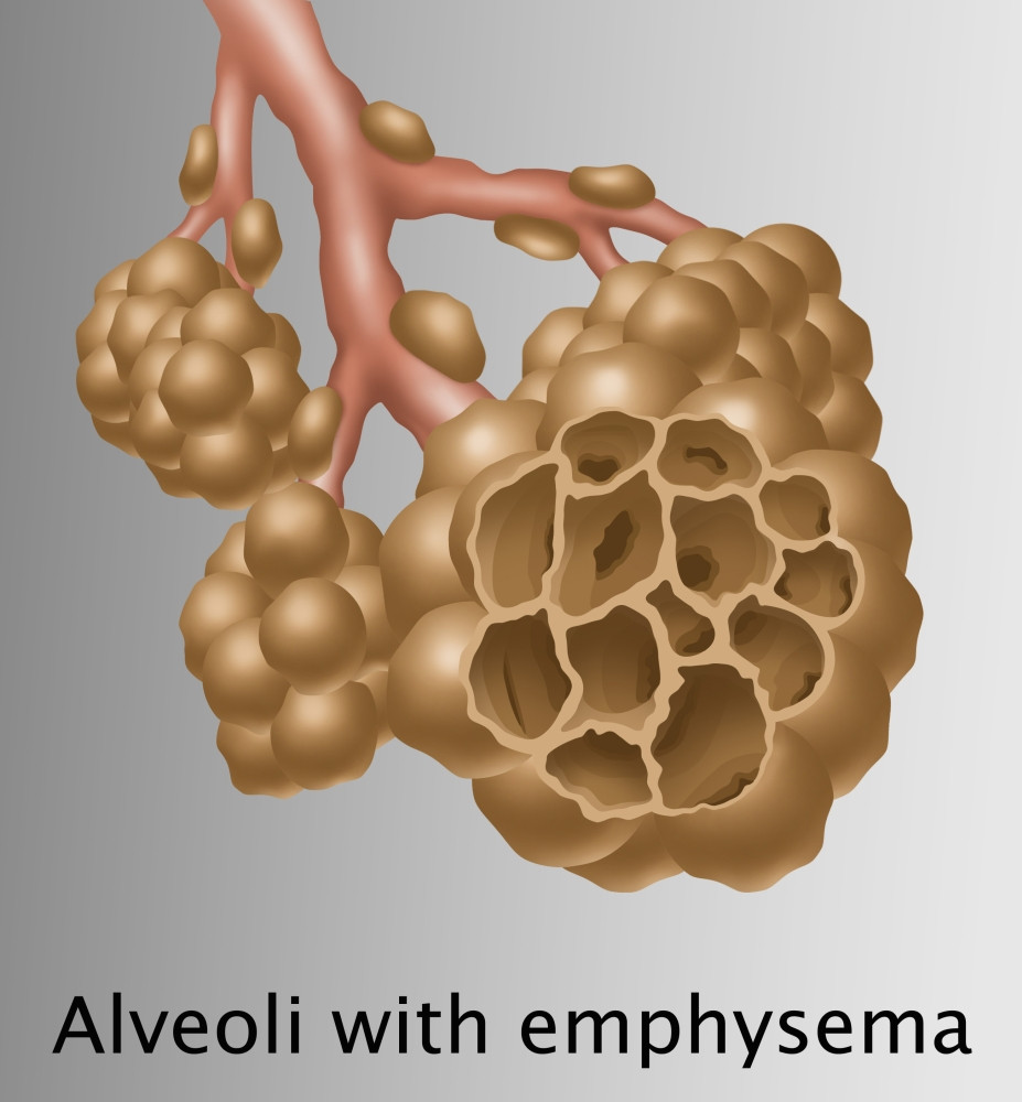 Alveoli with Emphysema Poster Print by Gwen Shockey/Science Source ...