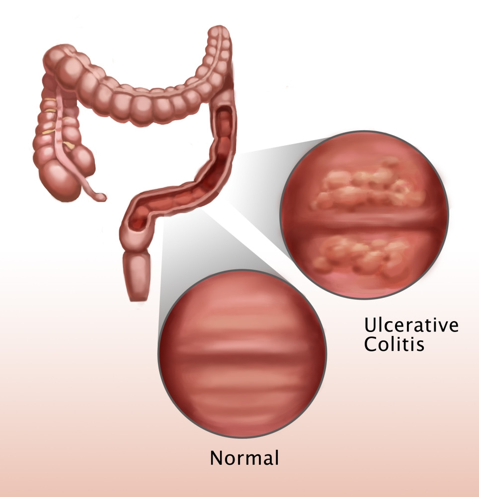 Ulcerative Colitis Poster Print by Spencer Sutton/Science Source - Item ...