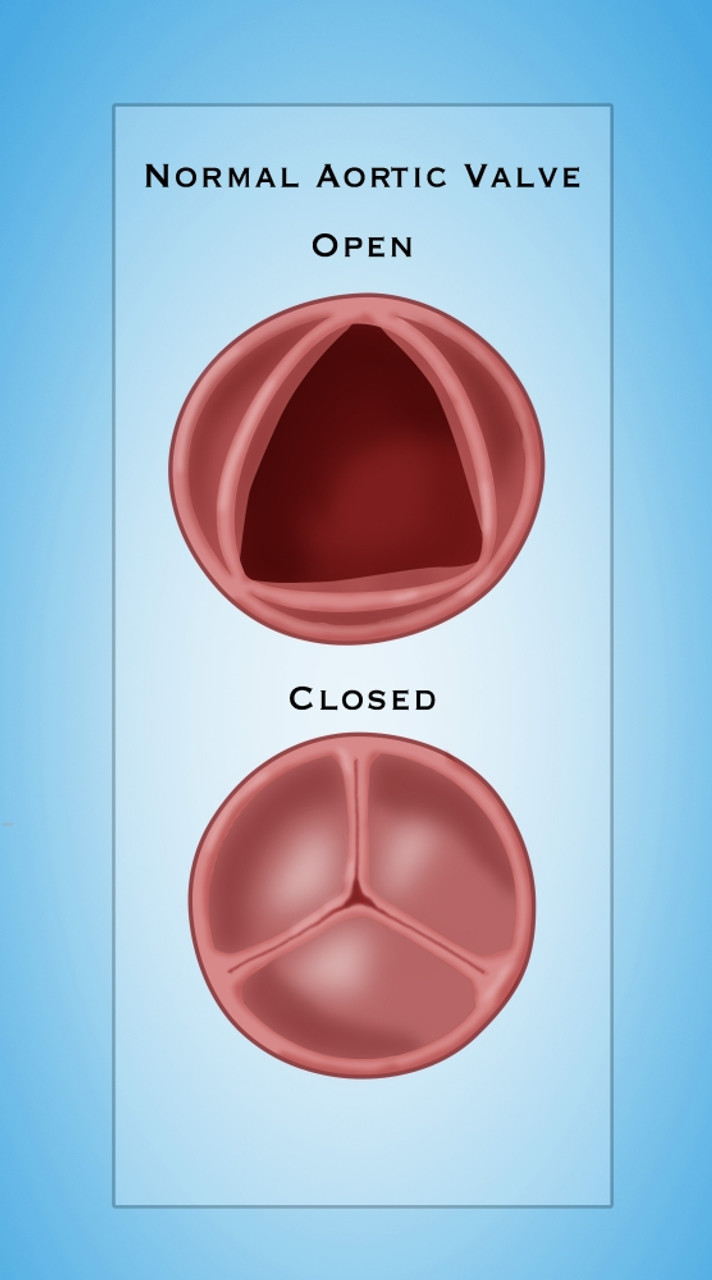 Normal Aortic Valve Poster Print by Monica Schroeder/Science Source ...