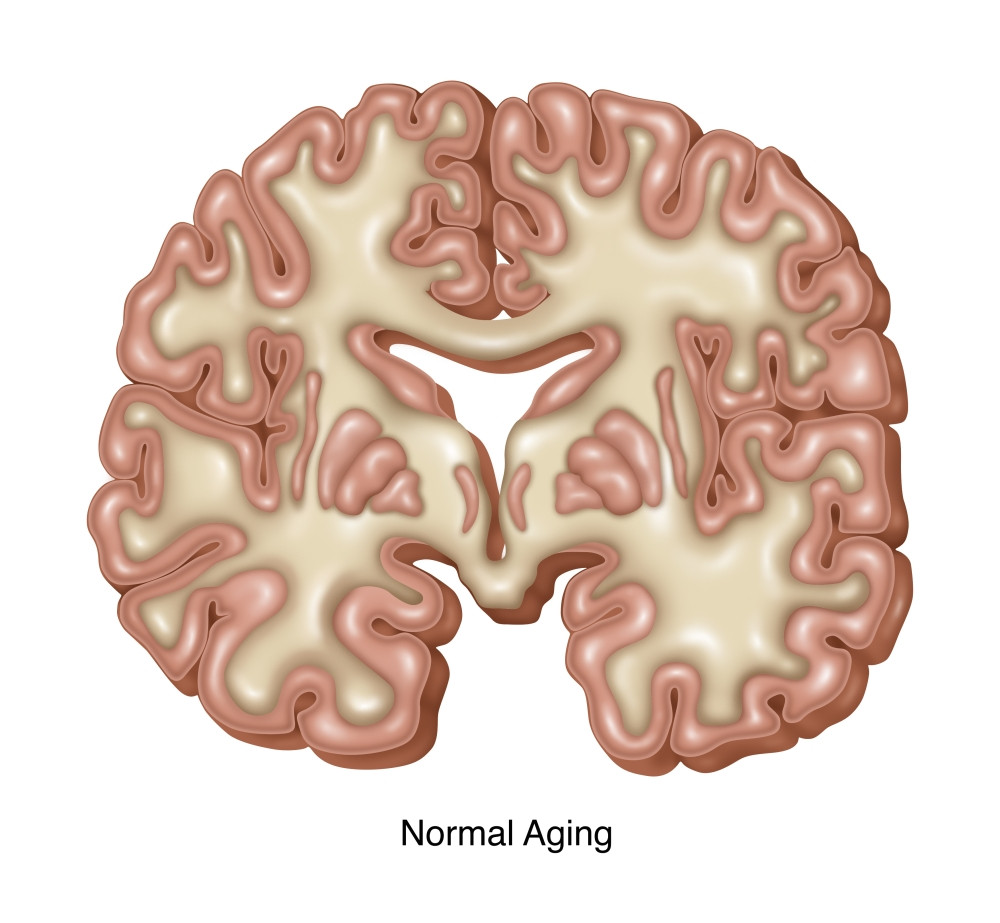 Normal Aging Brain Poster Print by Gwen Shockey/Science Source - Item ...