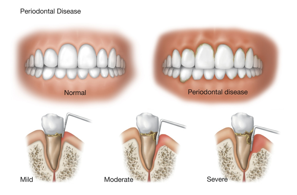 Three stages of periodontal disease. Poster Print by TriFocal ...
