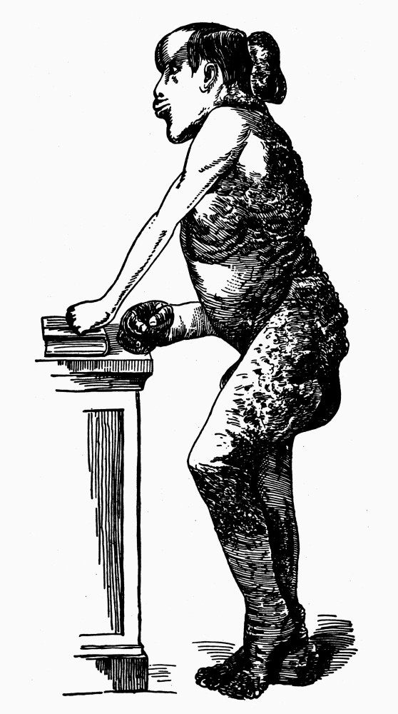 Joseph Merrick