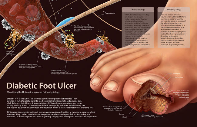 Diabetic Foot Care Posters