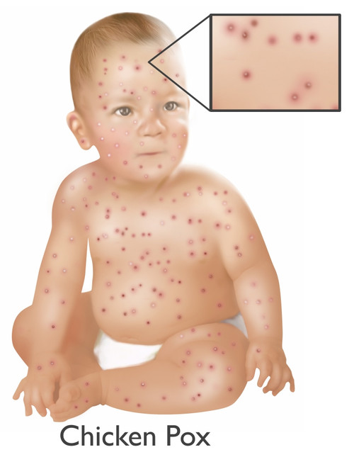Baby with Chicken Pox Poster Print by Gwen Shockey/Science Source ...