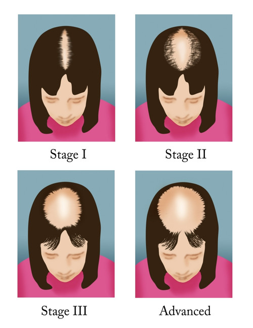 Stages of Female Hair Loss Poster Print by Monica Schroeder/Science ...