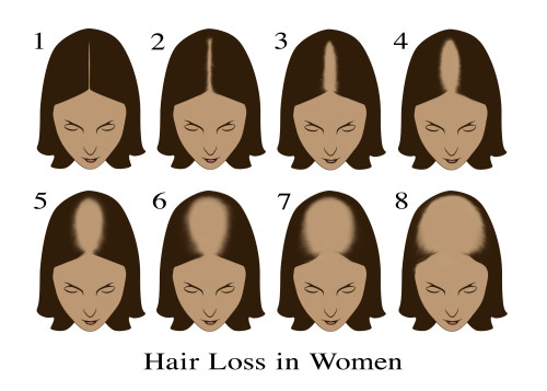 Hair Loss Poster Print by Gwen Shockey/Science Source - Item ...