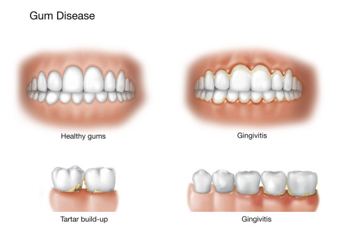 Comparison of healthy gums versus gingivitis. Poster Print by TriFocal ...