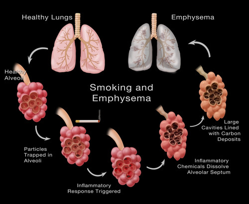 Lung Damage Leading to Emphysema Poster Print by Monica Schroeder ...