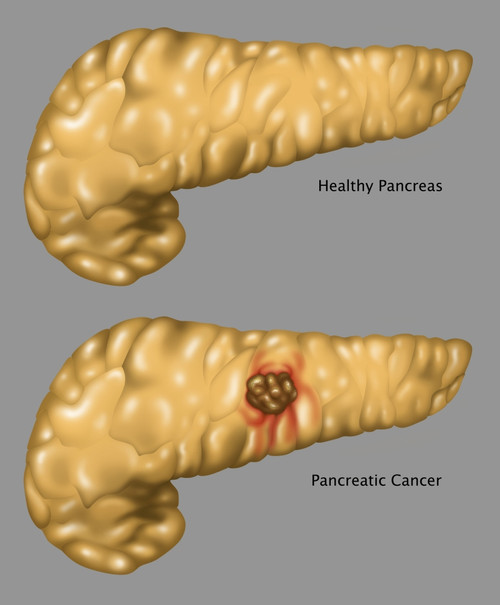Pancreas, Healthy & Cancerous Poster Print by Gwen Shockey/Science ...