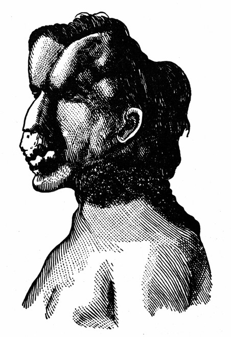 Joseph Merrick (1864-1890). /Nenglish Medical Anomaly, Known As The ...