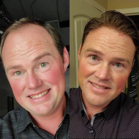 Real Hair Loss Help with Custom Hair Systems for Men - Cindycut
