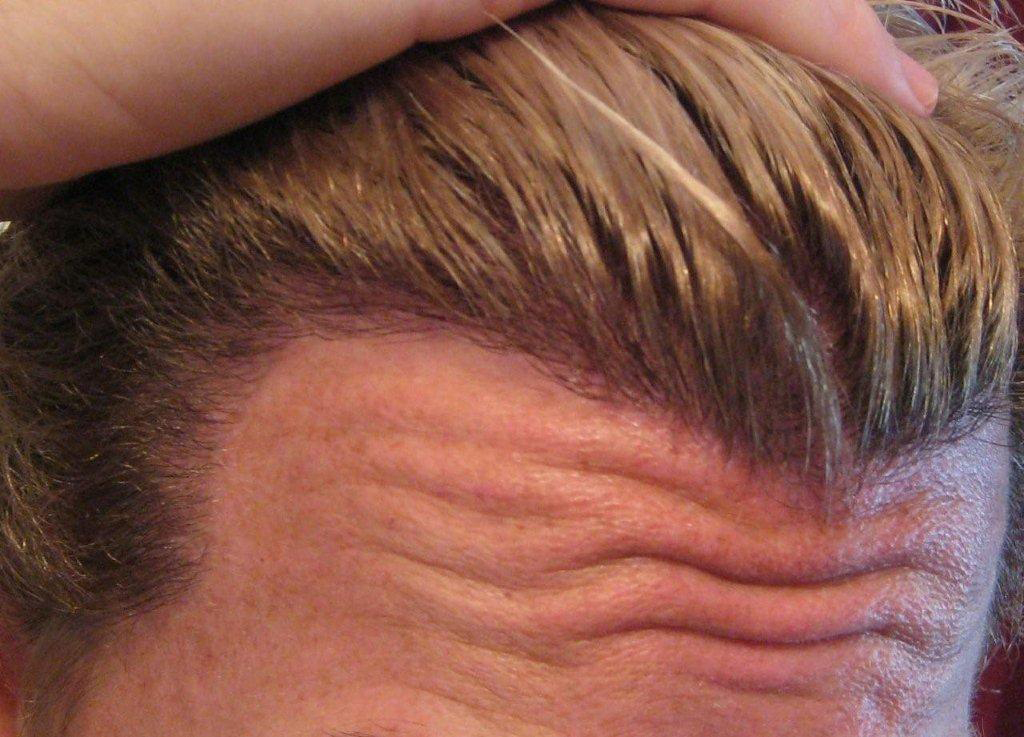 Mens hair replacement System procedures - Cindycut