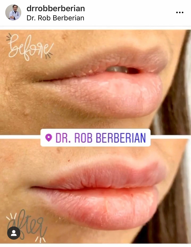 Lip Filler Newport Beach | Best Lip Fillers Orange County | Dr. Rob ...
