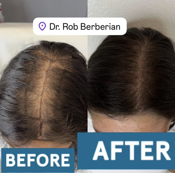 Hair Transplant Los Angeles | Dr. Rob Berberian | Best FUE Hair ...