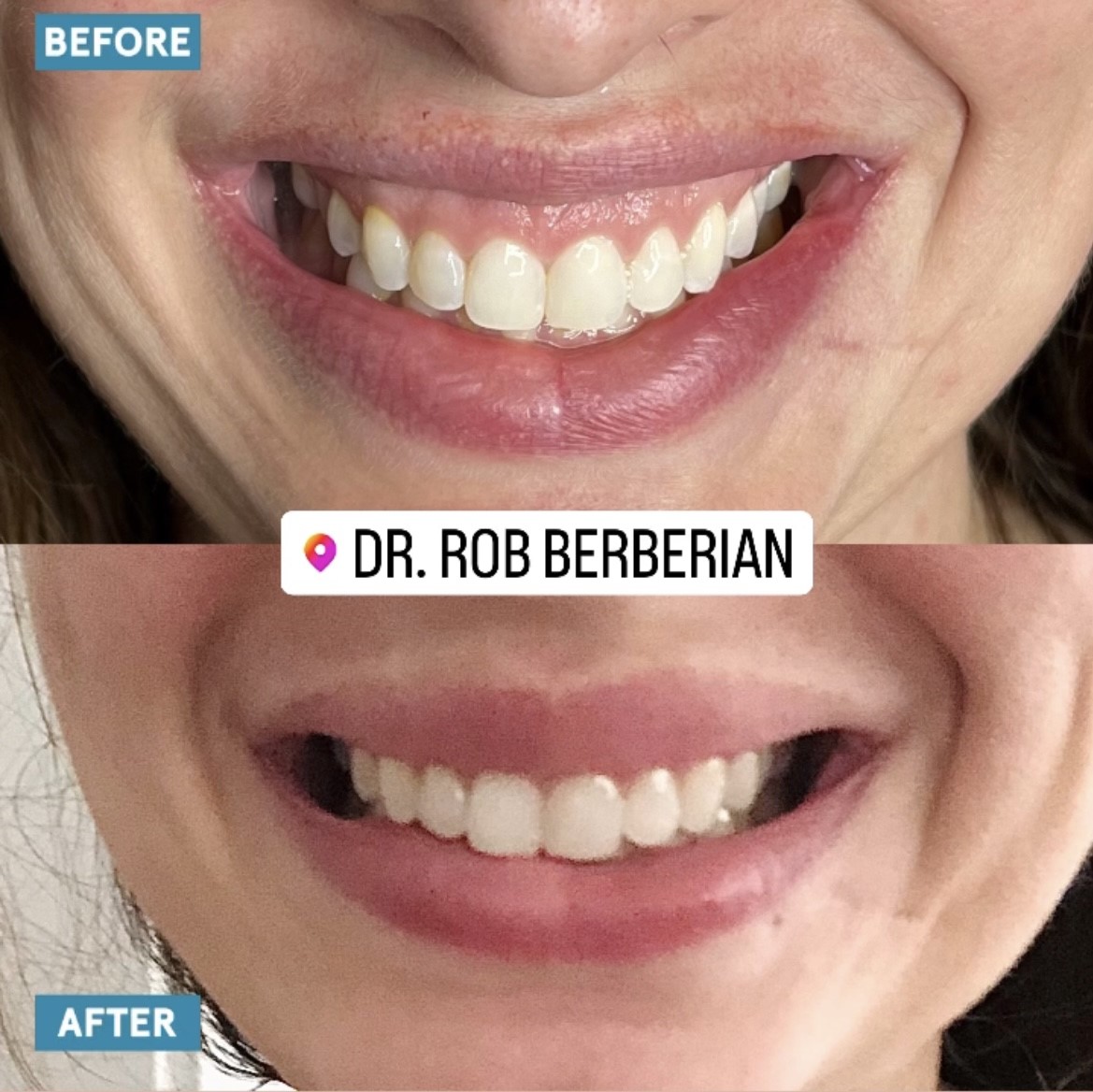 Can a gummy smile be corrected without surgery in minutes? - Dr. Rob ...