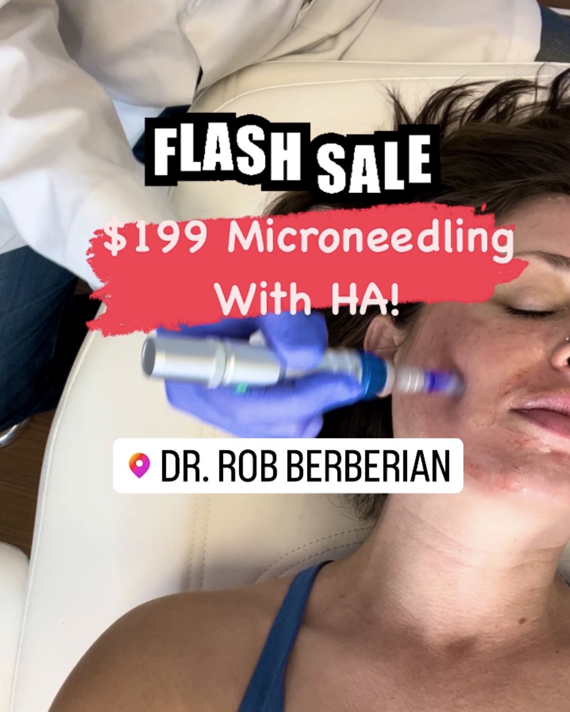 Microneedling Promo FB | Kisso Kisso Med Spa