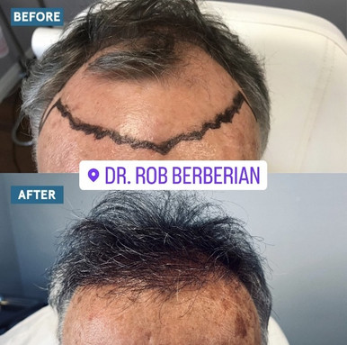 FUE Hair Transplant Timeline Los Angeles - Complete Recovery Guide | Dr ...