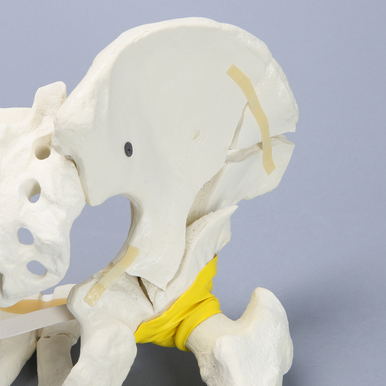 Pelvis with Both Column Fracture and Encapsulated Femur, Full Male ...