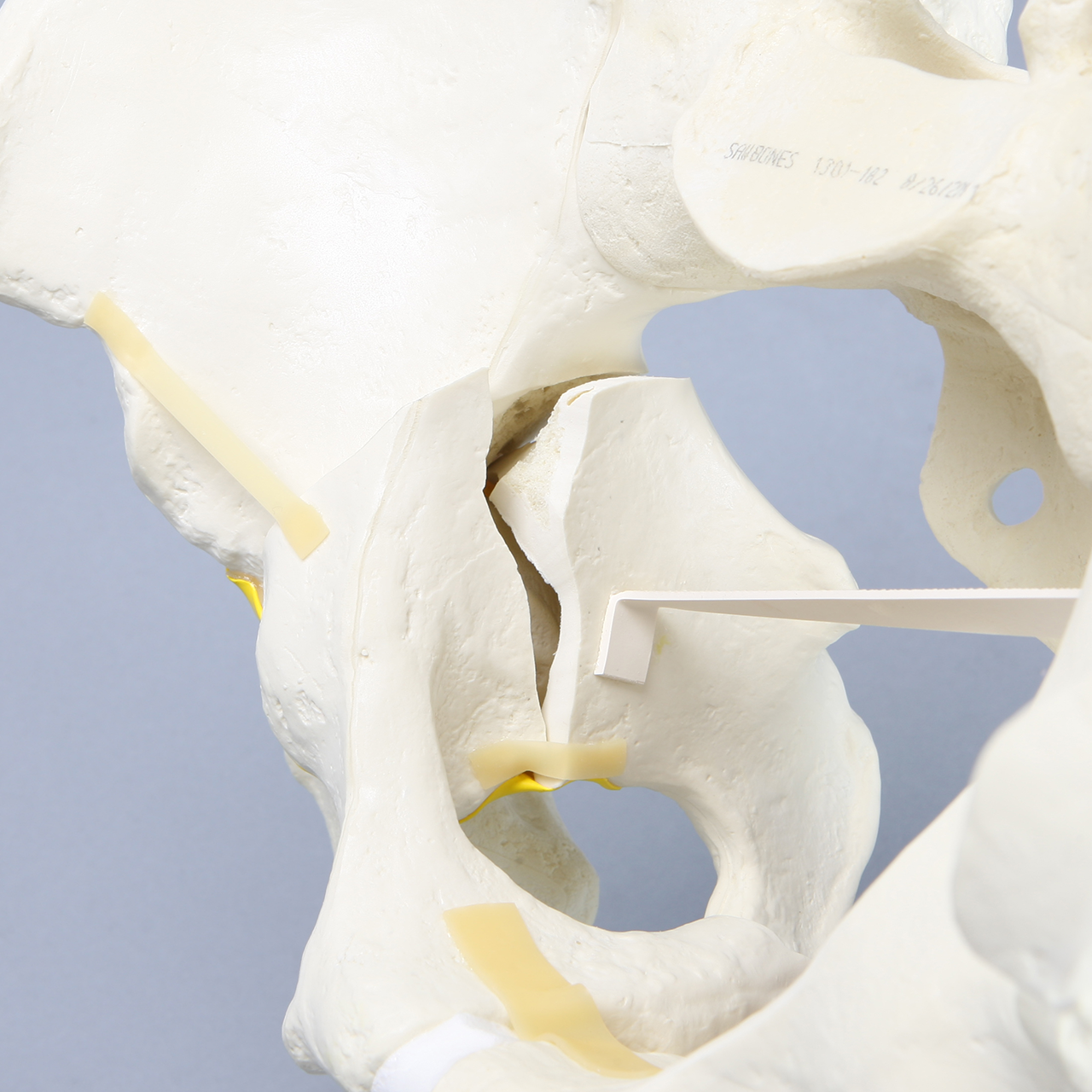 Pelvis with "T" Fracture, Displacement, and Encapsulated Femur, Full ...