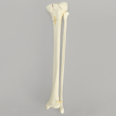 Tibia with Bicondylar and Transverse Fractures and Intact Fibula - Sawbones