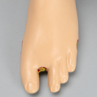Foot and Ankle with Multiple Pressure Wounds, Soft Tissue - Sawbones