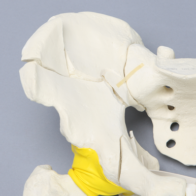 Pelvis with Both Column Fracture and Encapsulated Femur, Full Male ...