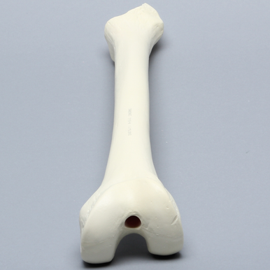 Femur with Focal Deficiency Type 2 - Sawbones