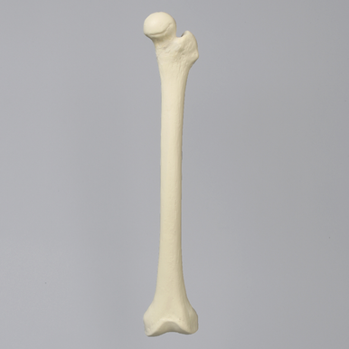 Femur with 155 Degree Neck Deformity - Sawbones
