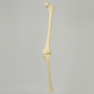 Knee with Distal Femur 40 Degree Hypoplastic Condyle Defect - Sawbones