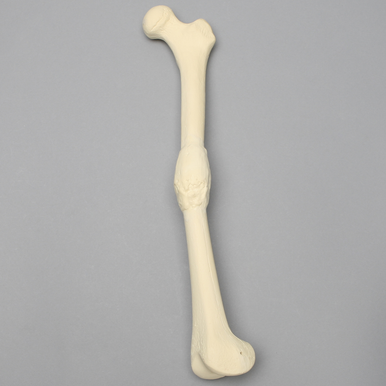 Femur with Midshaft Malunion and Anteversion - Sawbones