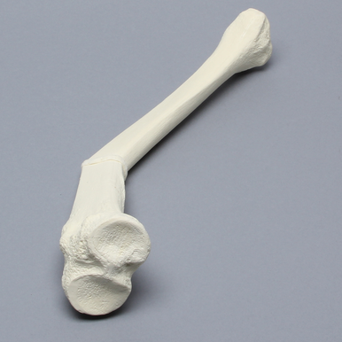 Tibia with Malunion and 25 Degree Procurvatum - Sawbones