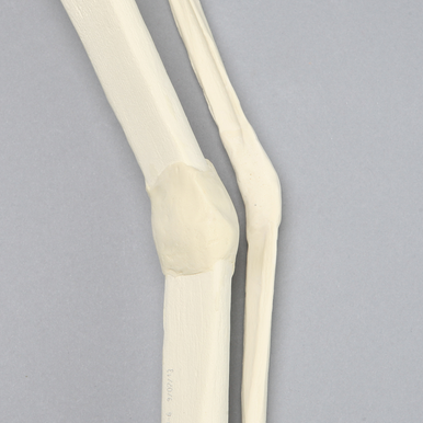 Tibia and Fibula with Malunions and 25º Varus Defect - Sawbones